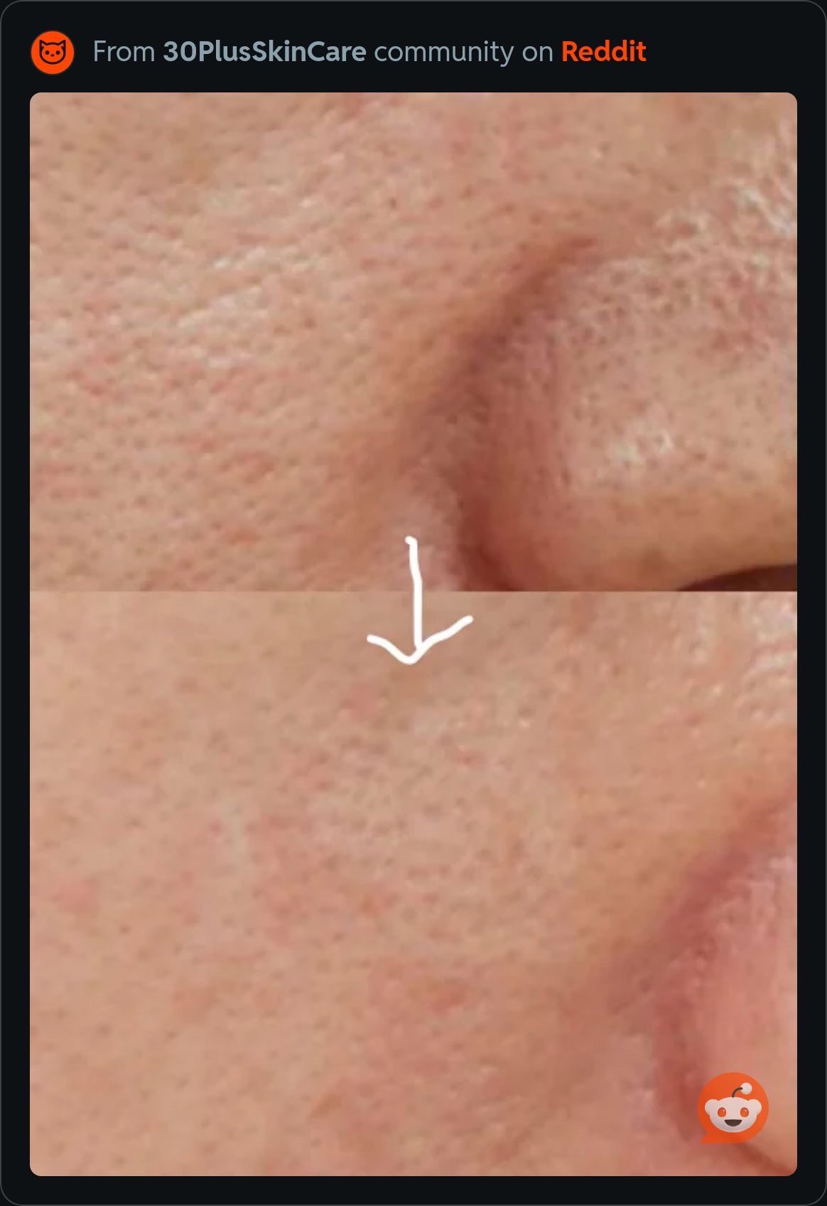 Medicube Zero Pore Pads 2.0 Review with Before and After